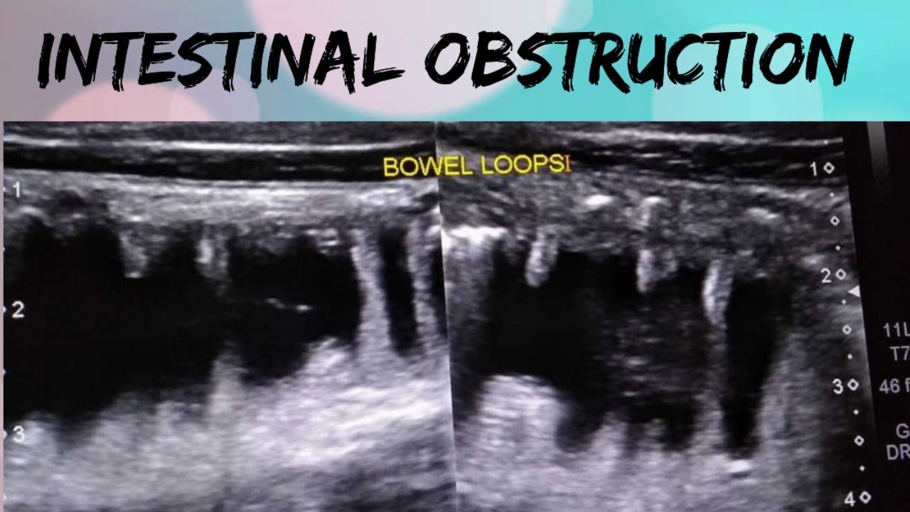 Intestinal Obstruction Ultrasound | Intestinal Health | Constipation ...