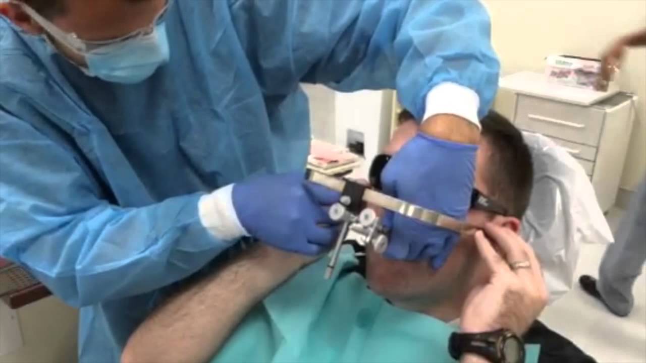 Mounting a Maxillary Cast Using a Facebow - YouTube