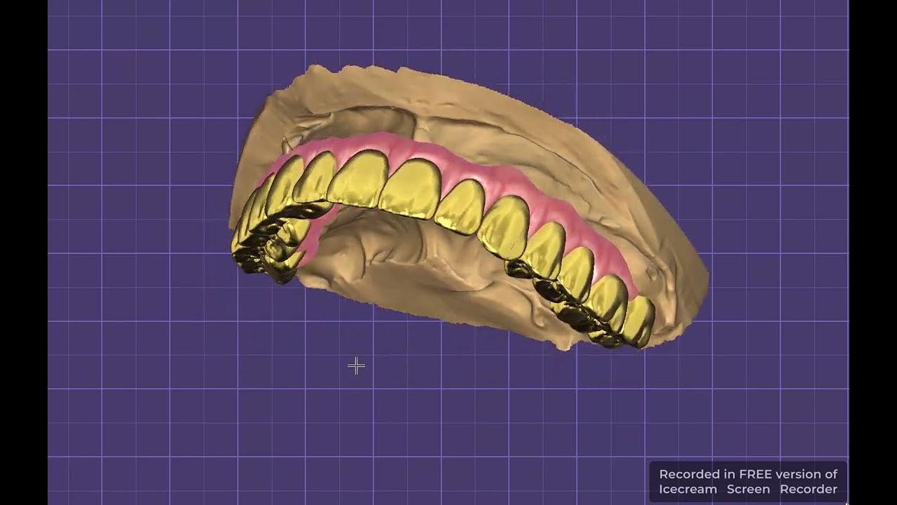 Exocad design Upper full arch implant bridge provisional - YouTube