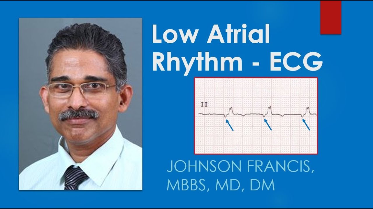Atrial Rhythm