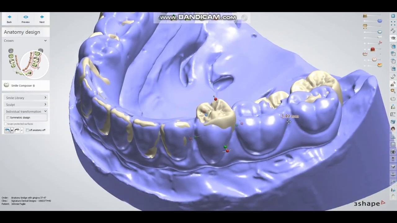 PMMA P1 demo bridge #37-47 on 3shape - Team CadCam - YouTube