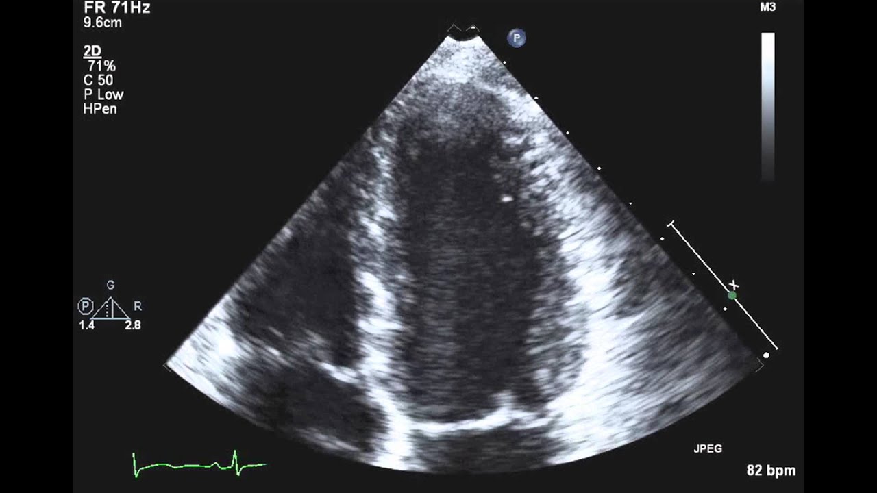 TTE Normal Apical 4 chamber LV zoom Example 1 - YouTube