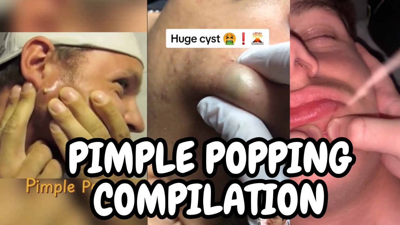 The BEST Pimple POPS Compilation - 2024 - YouTube