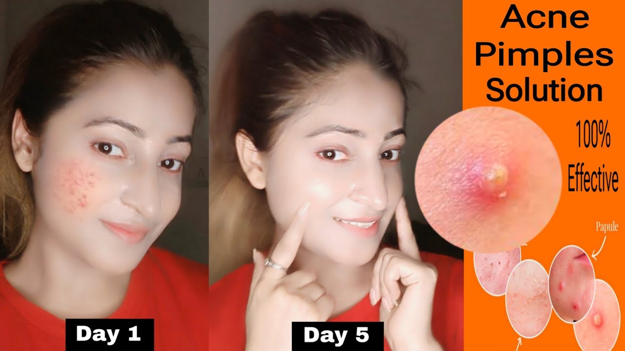 How to remove pimples naturally | Acne Treatment | Pimple & Acne ...