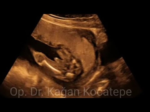 19 HAFTALIK (YAKLAŞIK 4.5 AYLIK) GEBELİK: ERKEK BEBEK ULTRASONOGRAFİDE NASIL GÖRÜNÜR? (AÇIKLAMALI)