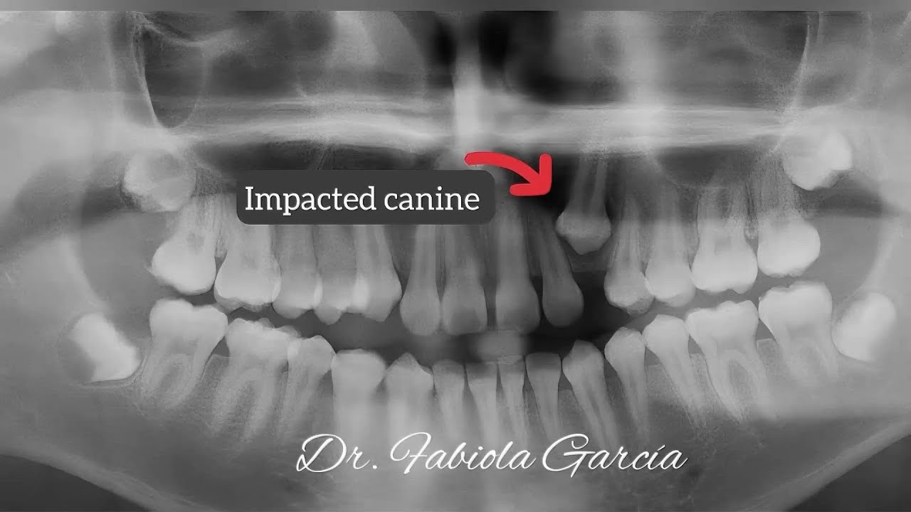 Impacted Tooth Exposure with braces #dentist #braces #invisalign # ...