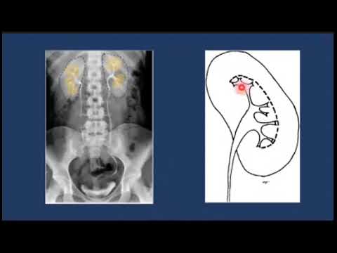 Pielograma Intravenoso - YouTube