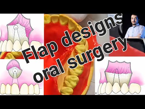 Instruments and flap designs of oral surgery. |Envelope| Triangular ...