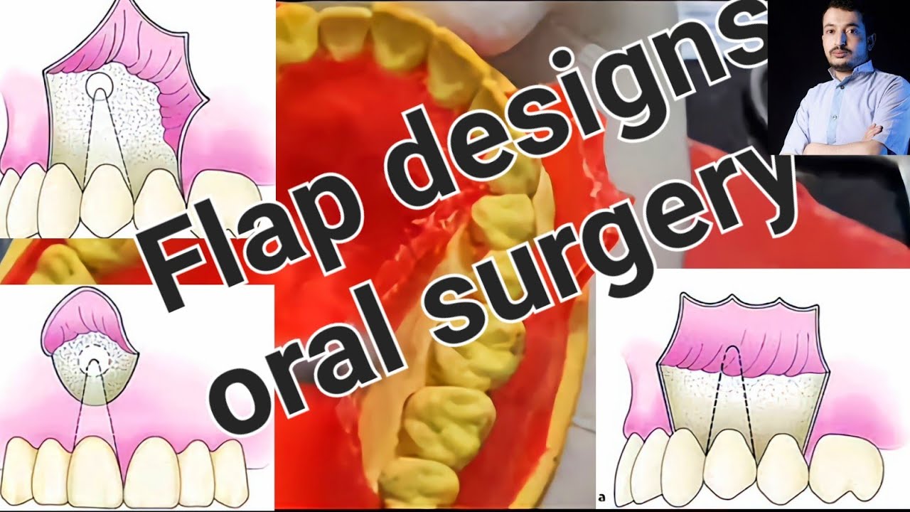 Basic principles of flap ( envelope, trapezoid, triangular and ...