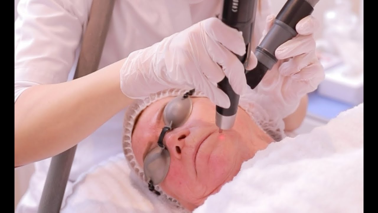 De Sparkle Laser Treatment: laserbehandeling voor een stralende huid ...