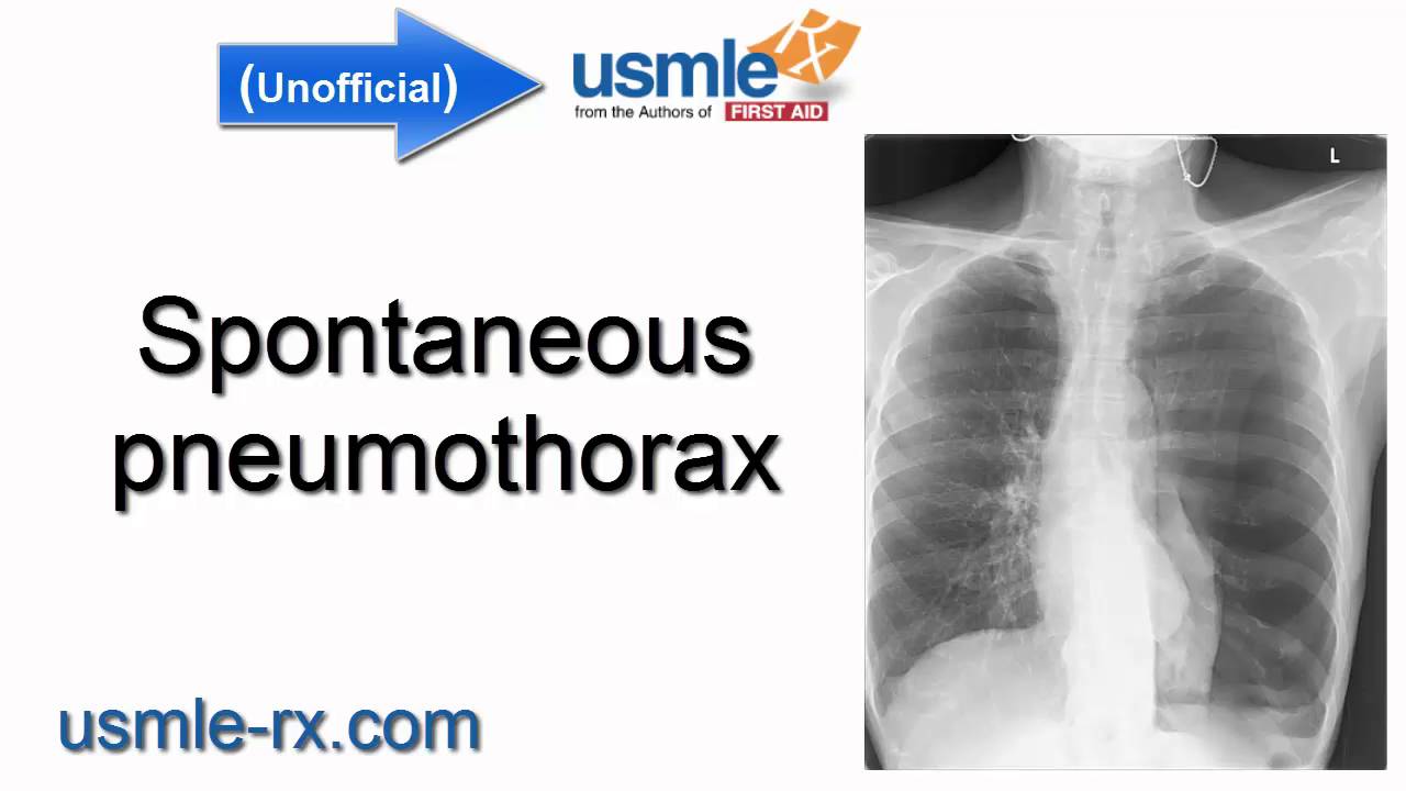 USMLE-Rx: Spontaneous pneumothorax - YouTube