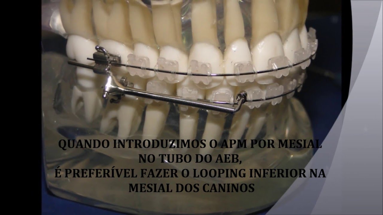 Como instalar um APM - Aparelho Propulsor Mandibular - Ortodontia fácil ...