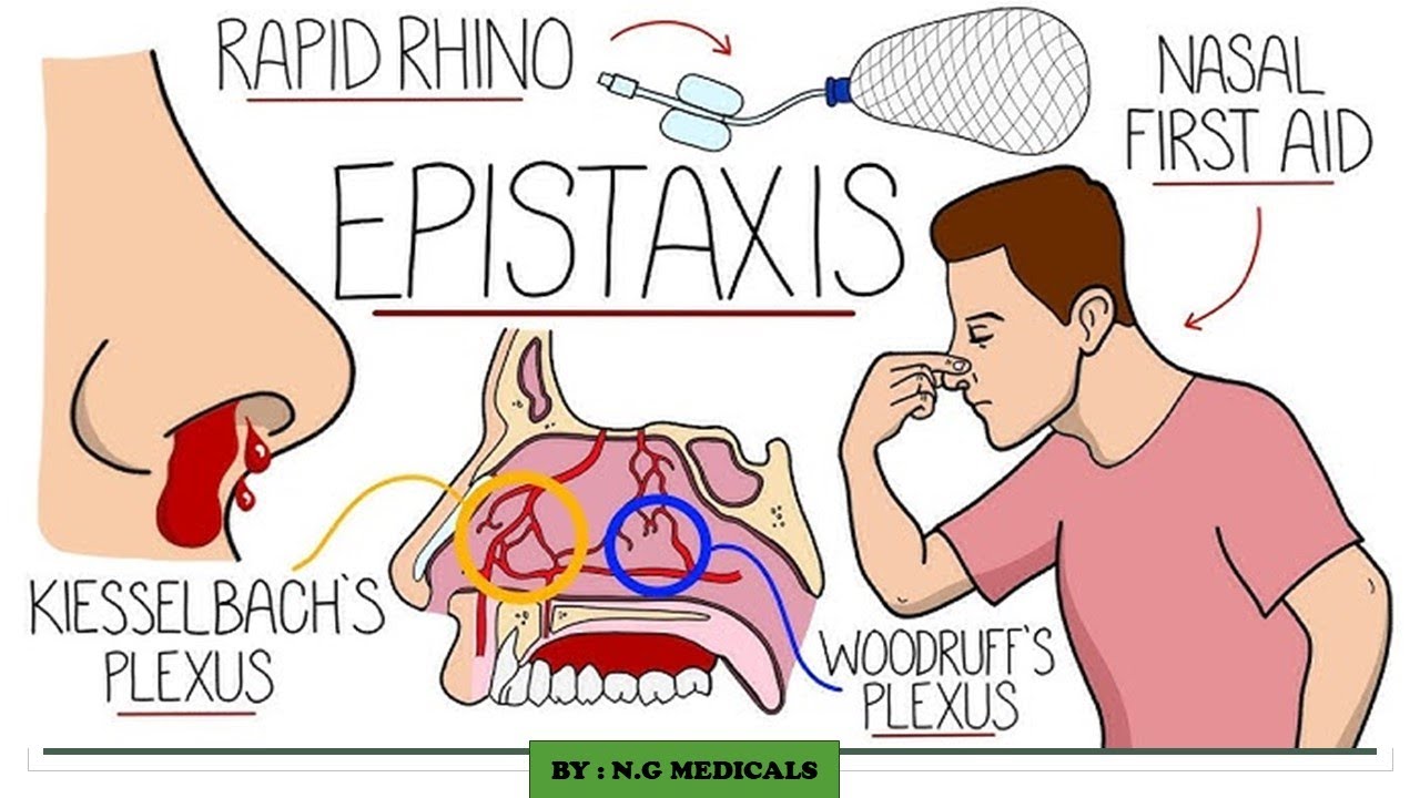 Epistaxis || Nose bleeding @NGMedicals - YouTube