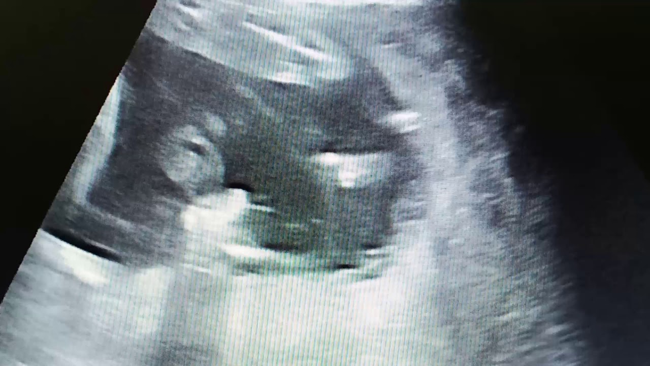 BILATERAL CTEV (DETAIL SCAN AT KLINIK DR ASMAH) - YouTube