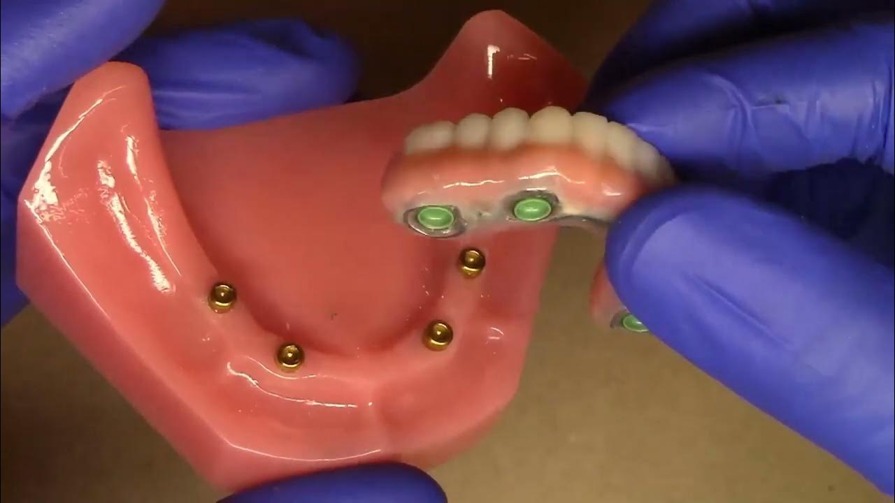 How to Place a LOCATOR FIXED Prosthesis with Dr. Michael Scherer - YouTube