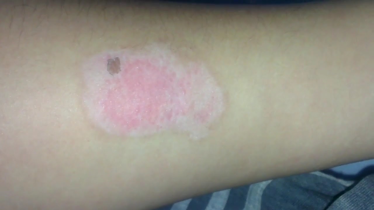 2 weeks after salt and ice challenge - YouTube