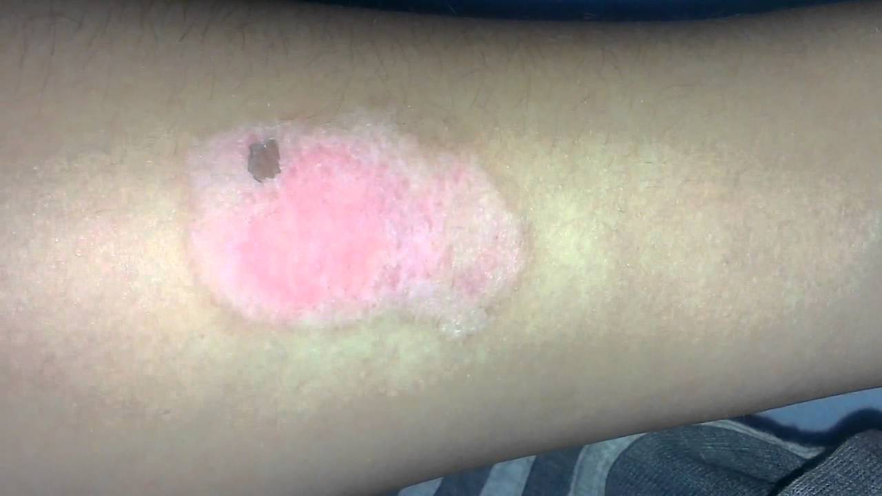 2 weeks after salt and ice challenge - YouTube