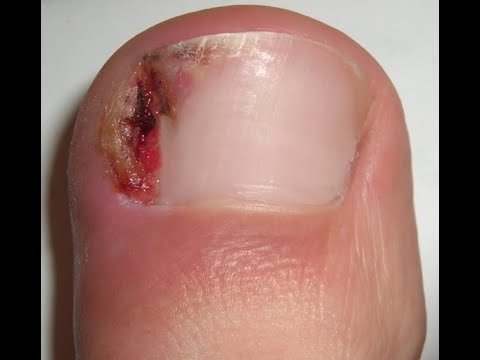 Ingrown Toenail Removal Surgery: Watch the Procedure and Recovery ...