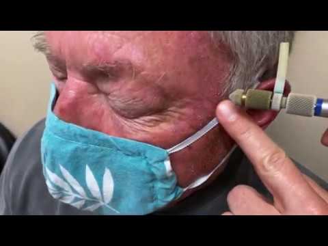 Cryotherapy for Actinic Keratosis | Auburn Medical Group - YouTube