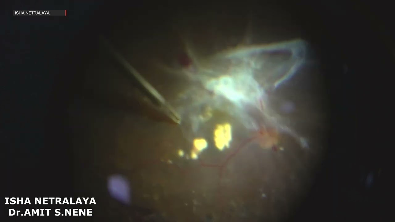 Advanced PDR TRD managed by vitrectomy - YouTube