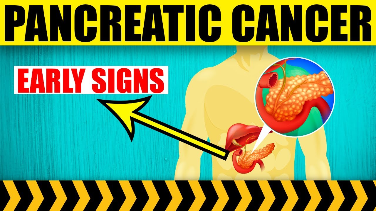 Unlocking the Hidden Clues: Pancreatic Cancer Signs You Must Know! 😮 ...