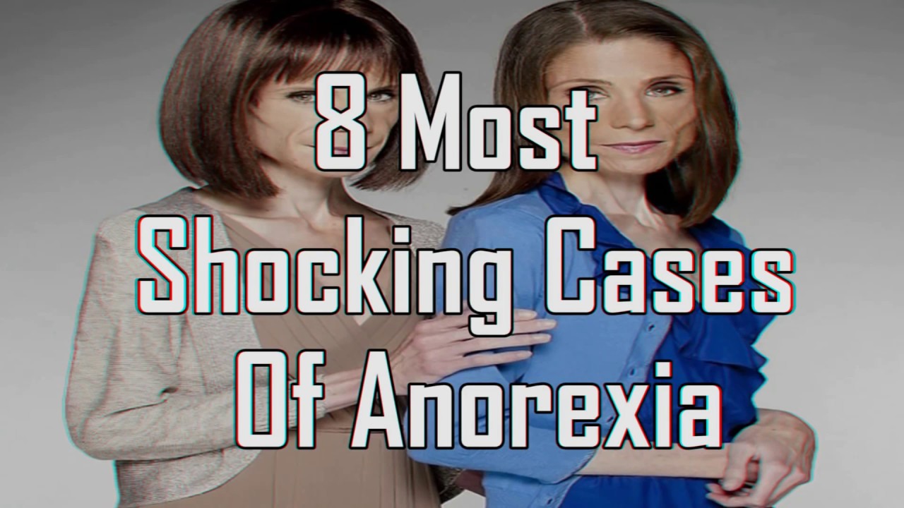 Shocking Cases Of Anorexia - YouTube