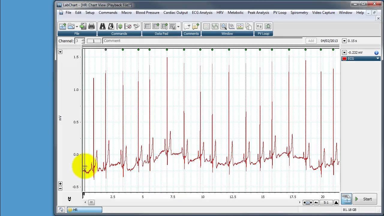 Using a Macro in LabChart to calculate RR intervals and Heart Rate Variability (HRV) - YouTube