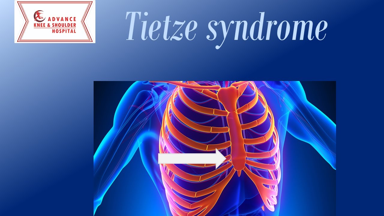 Teitze Syndrome - YouTube