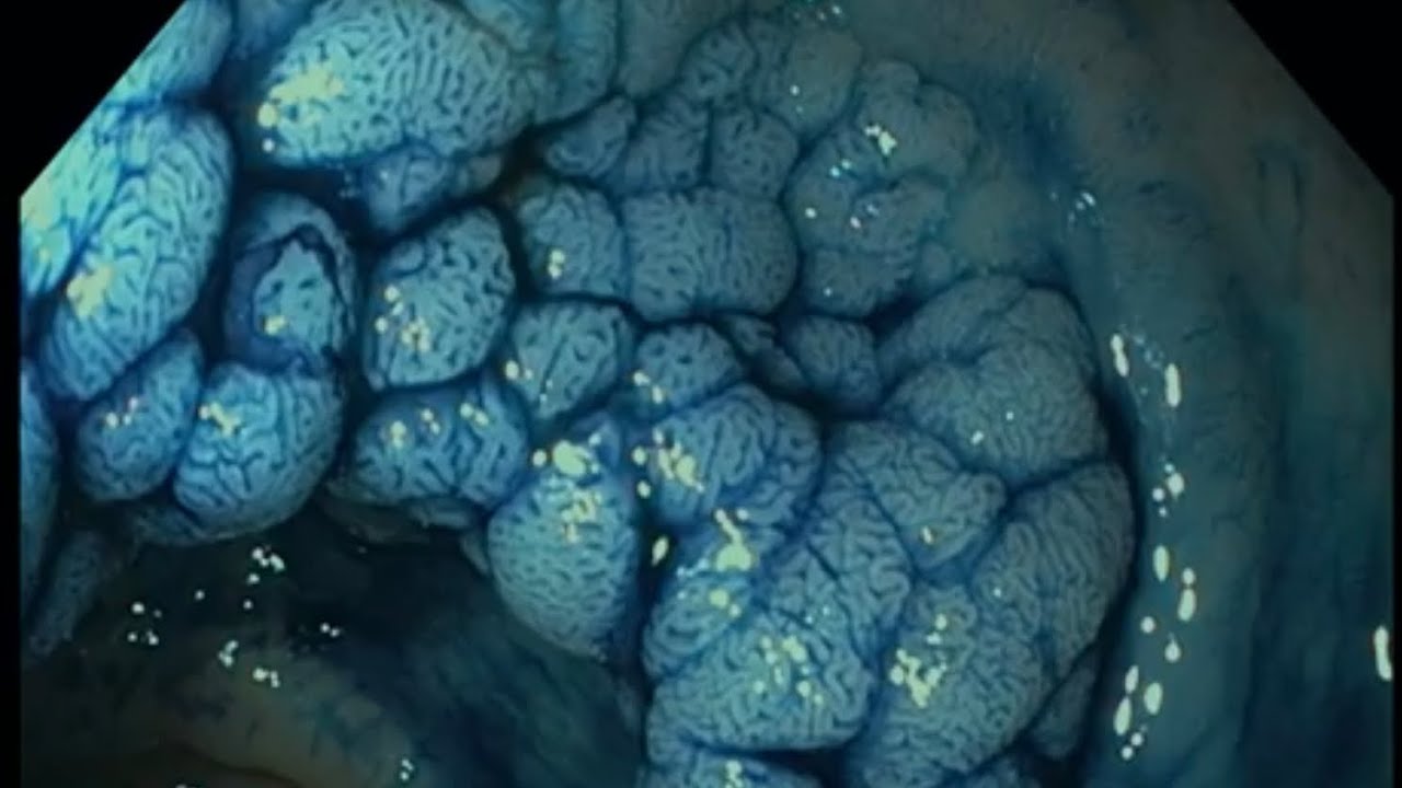 Rectal polyp ESD - YouTube