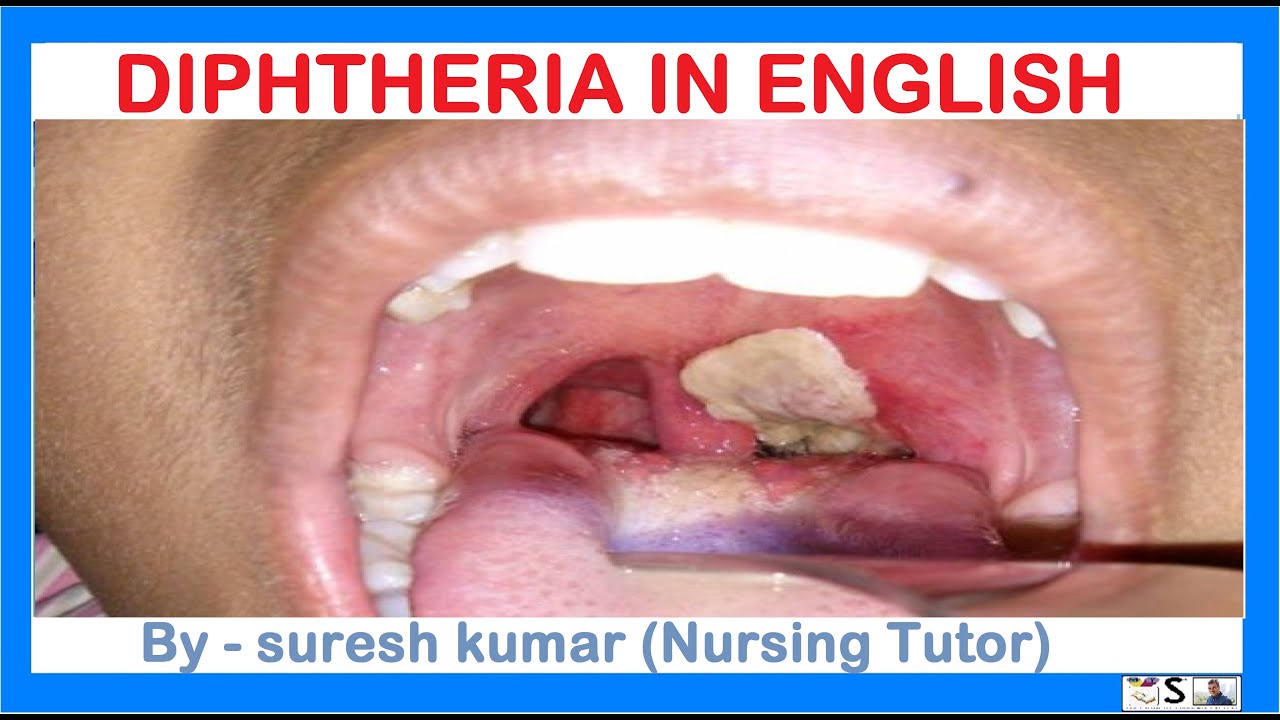 Diphtheria Pseudomembrane Removal