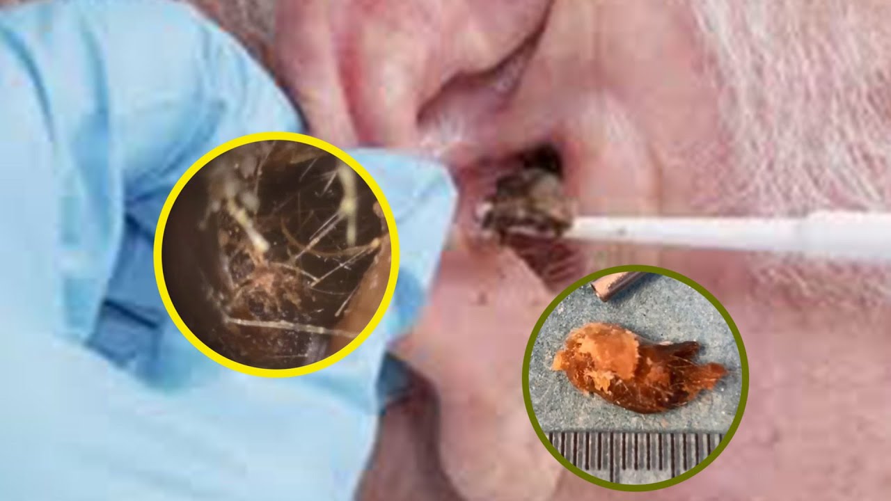 WoW! muddy ear wax removal for our health with relax music - YouTube