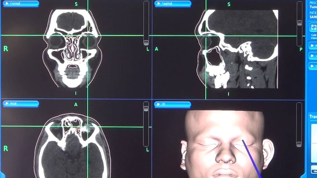 Navigation guided Orbital Foreign body removal - YouTube