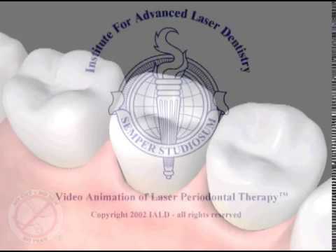 LANAP Animation - YouTube