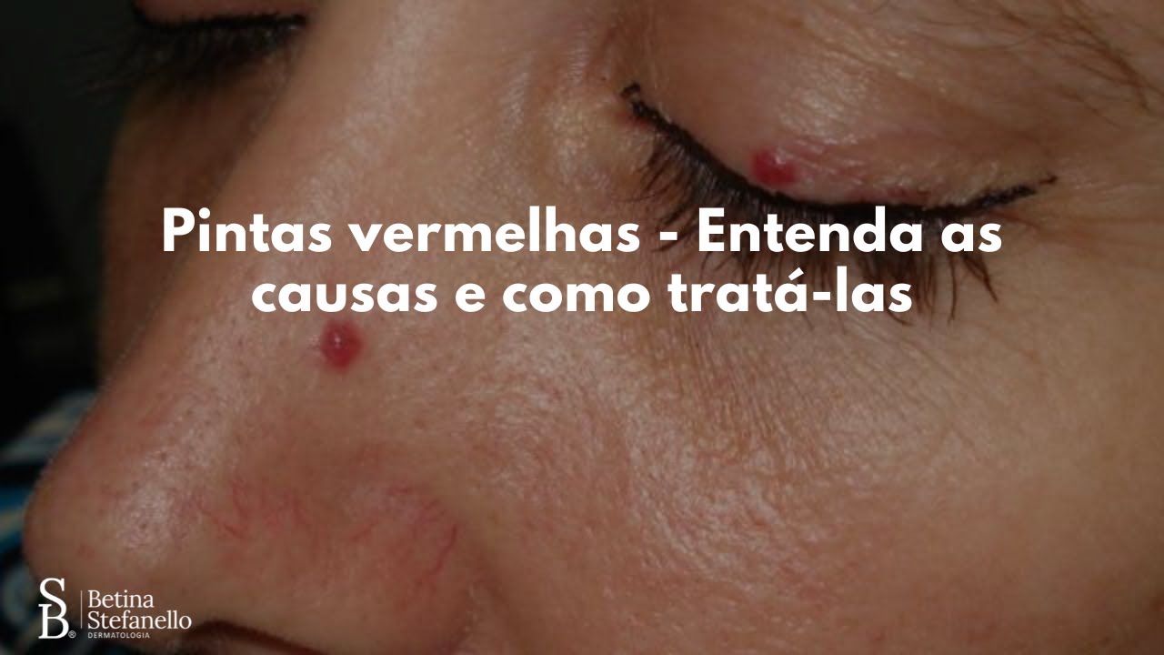 Pintas vermelhas Entenda as causas e como tratá-las! - Dra Betina ...