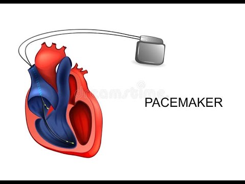 Pacemaker | Bradycardia | Arrhythmia | Heart Block | Cardiomyopathy ...