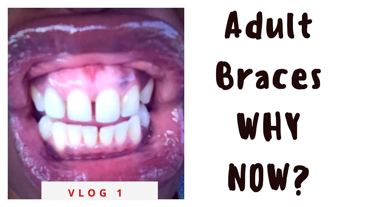 BRACES AFTER 30!! WHY NOW? - YouTube