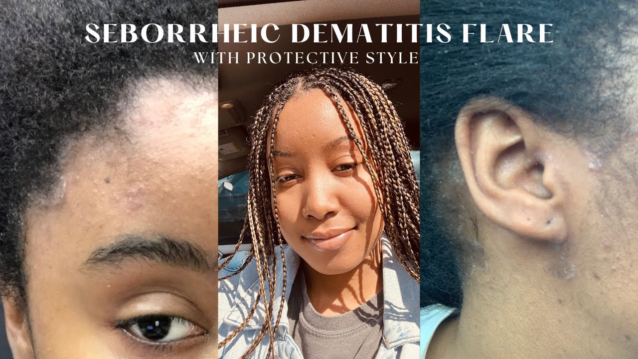 3 things I use for Seborrheic Dermatitis flare ups| #haircare # ...