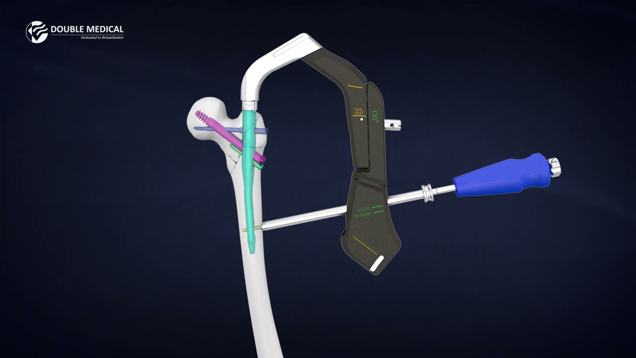 Double Medical Proximal Femoral Bionic Nail PFBN - YouTube