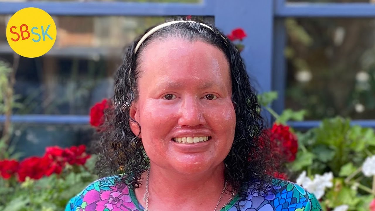 Life as an Adult with Ichthyosis (Carly Findlay's Story) - YouTube