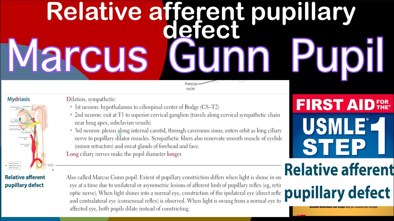 Relative afferent pupillary defect- Marcus Gunn pupil in Hindi/Urdu by ...