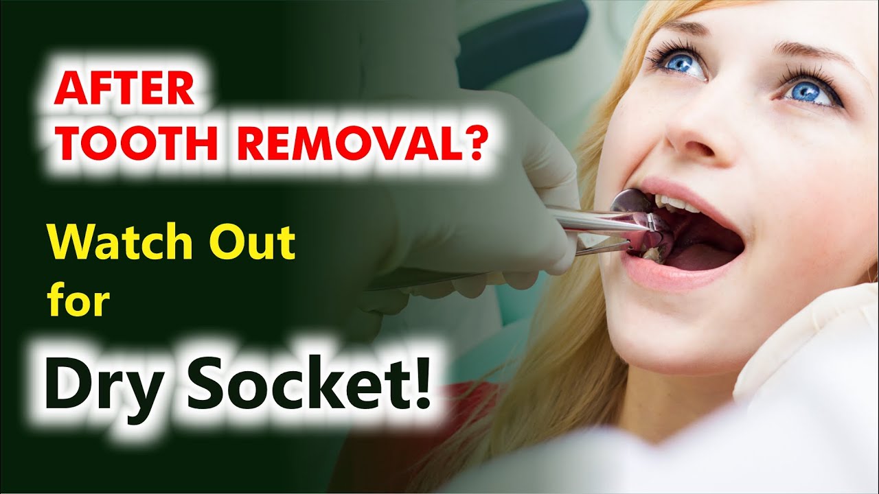 Dry Socket After Tooth Extraction? Causes, Symptoms & Fast Relief ...