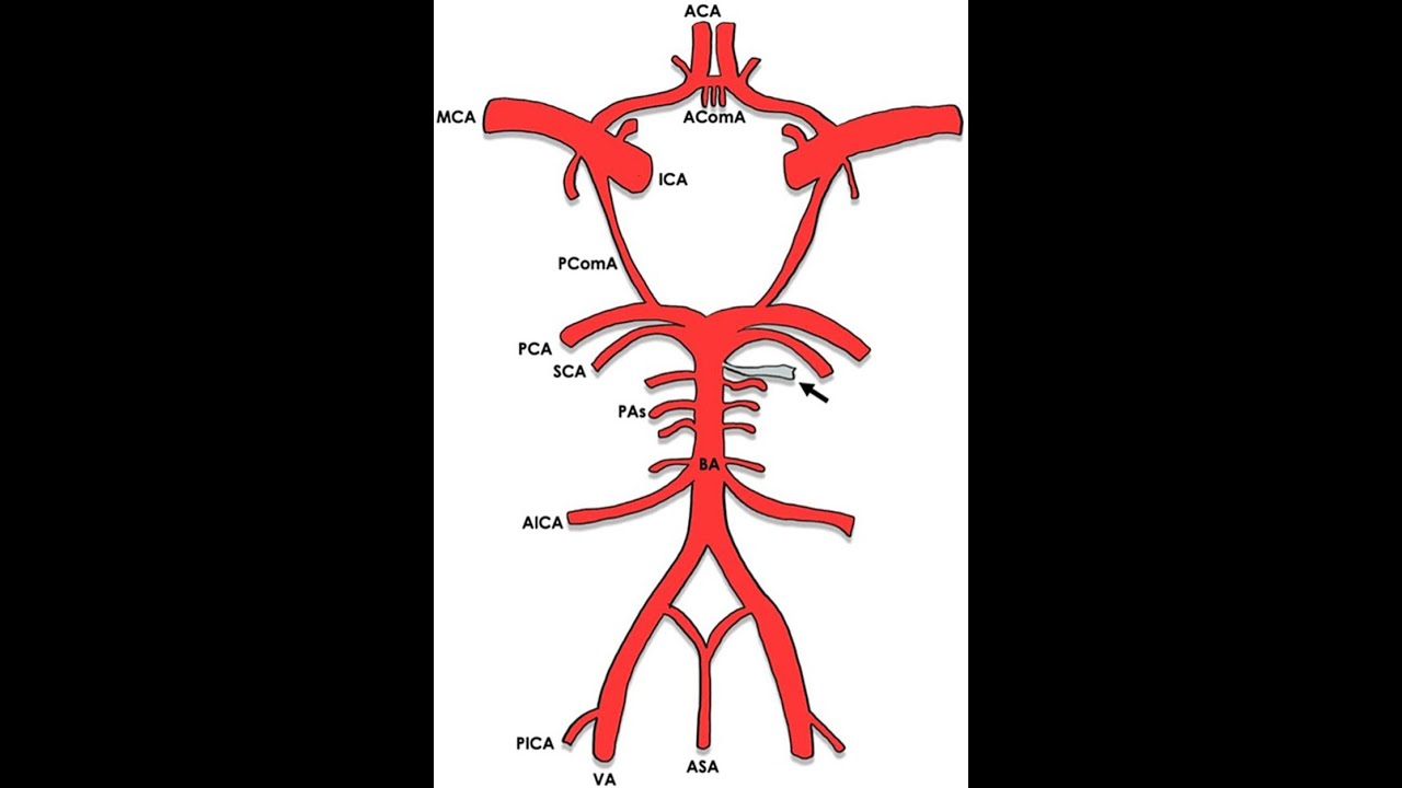 Gross Anatomy: The Circle of Willis: Stroke and hypertension, all you ...