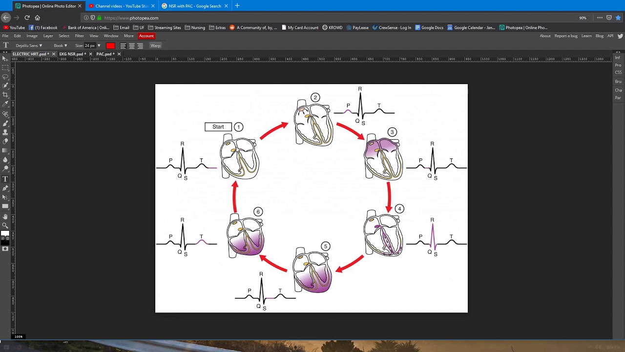 NSR with Premature Atrial Contraction "PAC" (Basics and Interpretation ...