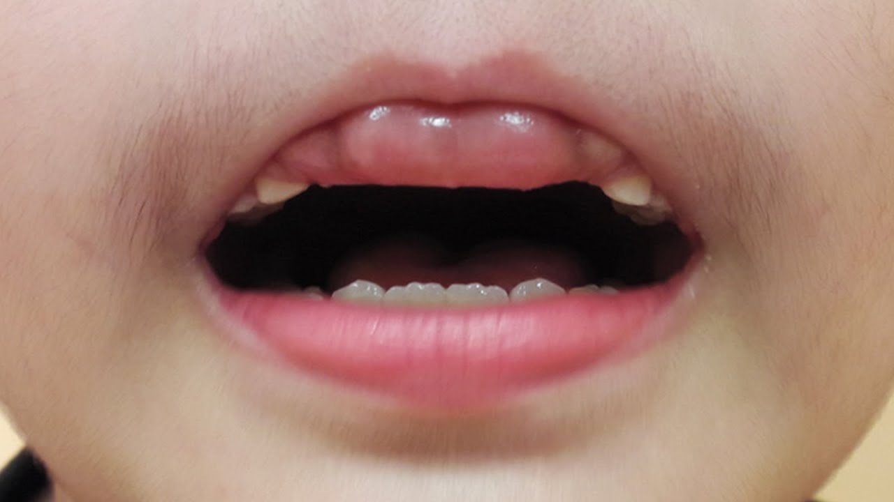 Why Did This 7 Year Old s Gum Tissue Swell So Much YouTube why-did-this-7-year-old-s-gum-tissue-swell-so-much-youtube