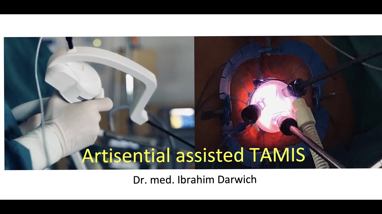 ArtiSential assisted TAMIS - YouTube