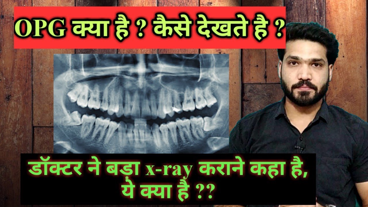 OPG क्या है ? कैसे देखते है ?OPG क्यों कराया जाता है ? - YouTube