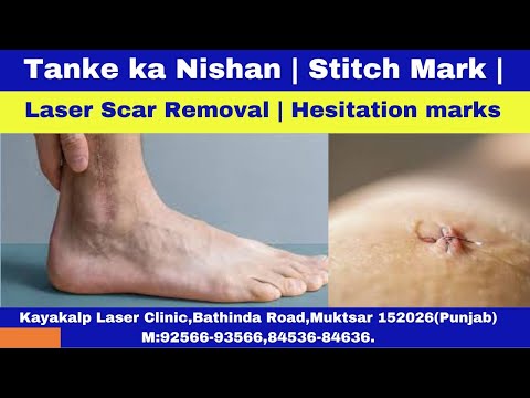 Tanke ka Nishan | Stitch Mark | Laser Scar Removal | Hesitation marks ...