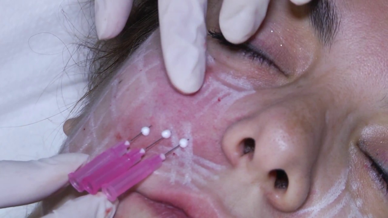 PDO Threads/Νήματα - Tear drop - YouTube