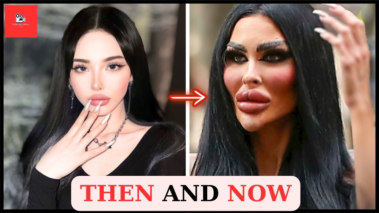 48 Celebrity Plastic Surgery Disasters Full Album | Then and Now 2025 ...