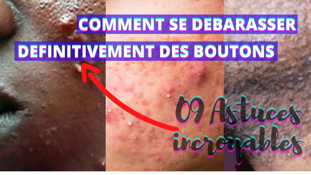 Comment éliminer définitivement les boutons sur le visage - YouTube